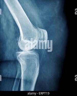 Farbige Profil Röntgen zeigt das rechte Knie eines 46 Jahre alten ...