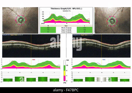 Optische Kohärenz Tomographie Augenuntersuchung mit einem Topcon OCT ...
