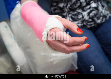 Gebrochenes Handgelenk mit einem Gipsverband Stockfotografie - Alamy