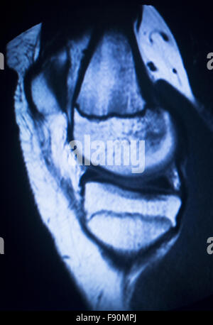 Querschnitt durch einen Oberschenkelknochen zeigt die anatomische ...