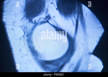 Querschnitt durch einen Oberschenkelknochen zeigt die anatomische ...