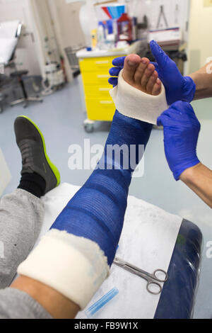 Gips auf einem gebrochenen Bein Stockfoto, Bild: 93030286 - Alamy