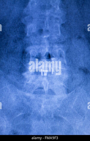 Wirbelsäule, Rücken und orthopädische Titan spinale Metallplatte ...