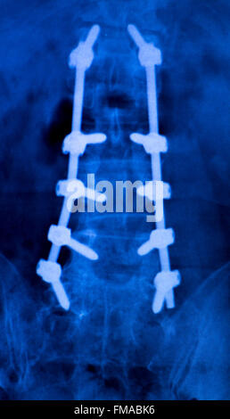 Wirbelsäule, Rücken und orthopädische Titan spinale Metallplatte ...