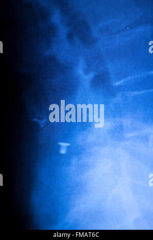 Wirbelsäule, Rücken und orthopädische Titan spinale Metallplatte ...