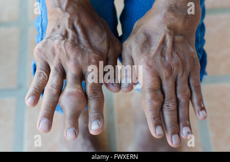 Finger des Patienten mit Gicht Stockfoto, Bild: 102000634 - Alamy
