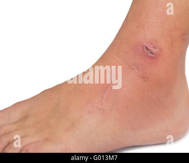 Fleischwunde Schorf auf Knie- und Narbe wegen fallender Stockfotografie ...