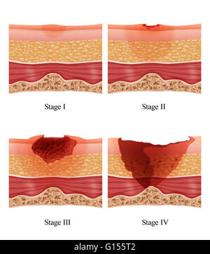 Stadien des Dekubitus Stockfoto, Bild: 49341605 - Alamy