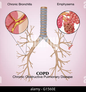 Illustration von chronisch obstruktiver Lungenerkrankung (COPD), einer ...