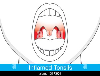 Medizinische Darstellung der Symptome der Mandelentzündung Vektor ...