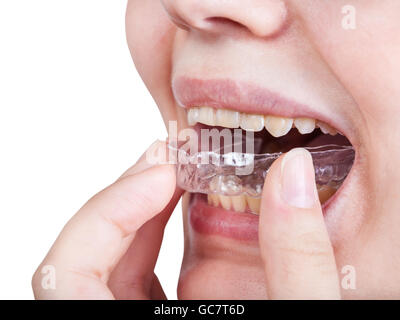 Mund mit Halter Spange für die Zähne. Kieferorthopädie Dental Thema ...