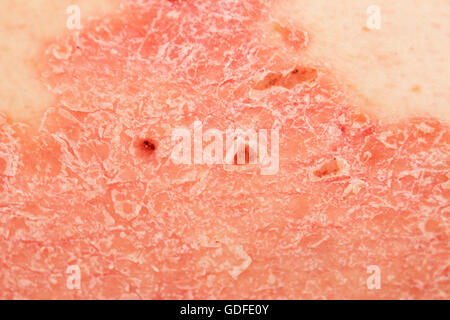 Psoriasis autoimmunkrankheit wie trockene rote Flecken auf der Haut als ...
