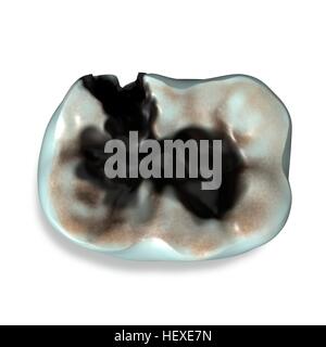 Molaren Karies, Abbildung Stockfotografie - Alamy