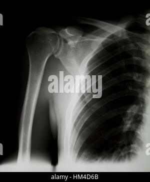 Röntgenbild Schulter Röntgen Stockfoto, Bild: 74765788 - Alamy