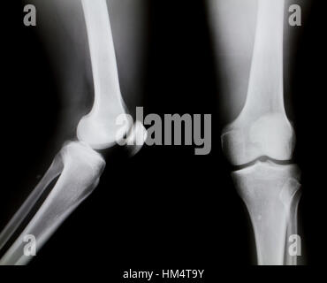 Rechtes Knie Röntgen Stockfoto, Bild: 103291733 - Alamy