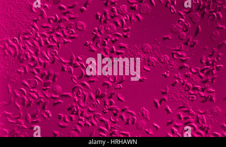 Sichel-Zelle Krankheit Sichelzellen-Anämie oder Drepanocytosis ist ...