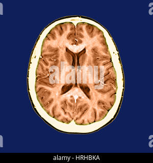 Normale Cross Sectional MRT des Gehirns Stockfoto, Bild: 134986861 - Alamy