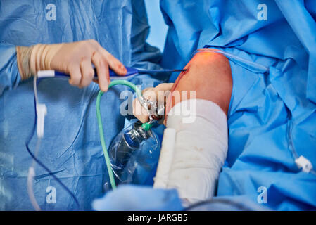 Team von Chirurgen und Krankenschwestern laparoskopische minimal ...