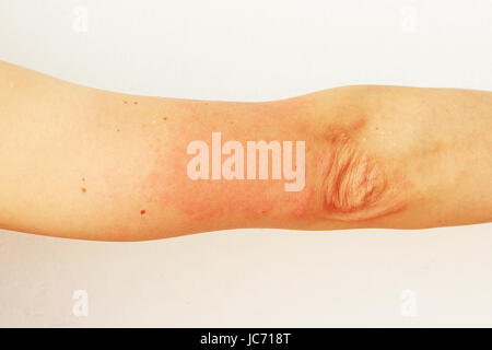 Rote Pusteln und Vesikel auf der Haut der Hand als Symptome der ...