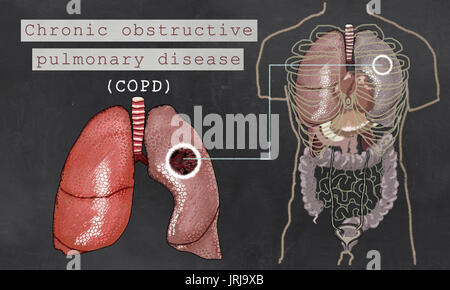 Illustration von chronisch obstruktiver Lungenerkrankung (COPD), einer ...