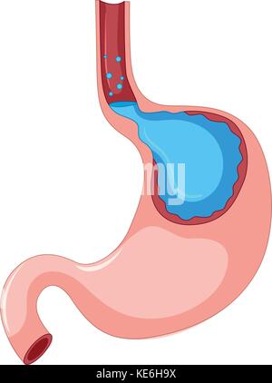 Gastroösophageale Refluxkrankheit Anatomie illustration Stock ...