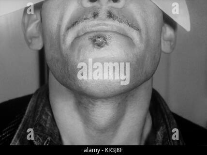 Primäre Syphilis Schanker Stockfotografie - Alamy