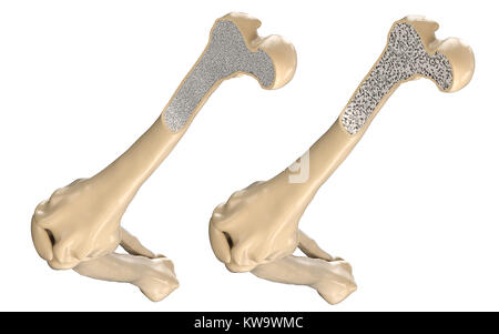 gesunde Knochen Osteoporose Stockfotografie - Alamy