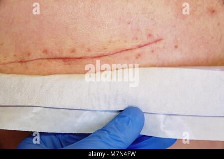 Patienten mit einem frischen lange Narbe nach einer Hüftchirurgie ...