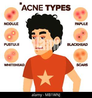 Arten von Akne Pickel. Gesunde Haut, Whiteheads und Blackheads, Papeln ...
