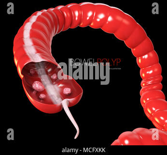 Menschlichen Dickdarm Polypen, Abbildung Stockfoto, Bild: 79463899 - Alamy