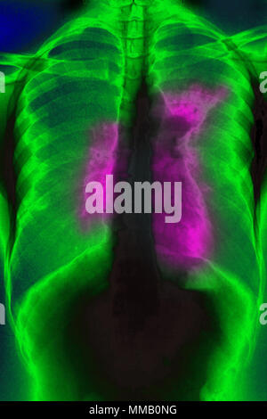 Lungentuberkulose. Röntgen-Thorax: Rechte Lunge Atelektase und ...