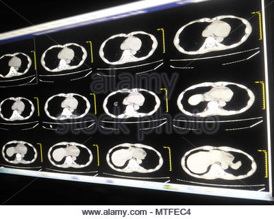 Herz und Lunge. Computertomographie (CT)-Scan der Brust eines gesunden Erwachsenen zeigen ...