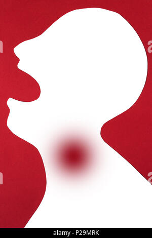 Mandelentzündung. In der Nähe von offenem Mund mit Entzündeten Mandeln ...