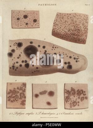 Hautkrankheiten: violette Flecken, Purpura Simplex und p. Haemorrhagica ...
