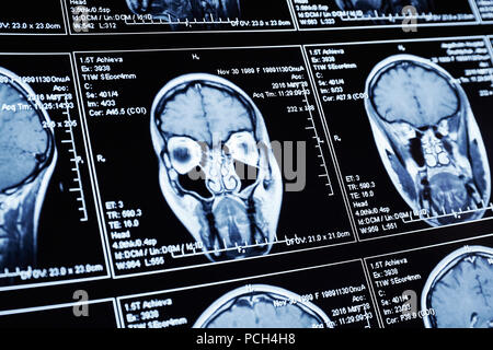 MRT Kopf Scan Stockfoto, Bild: 112601763 - Alamy