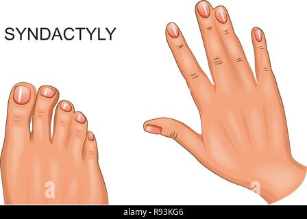 Medizinische Illustration zeigt Karpaltunnel-Syndrom in der ...