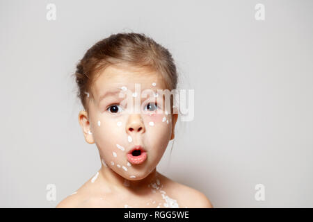 Closeup überrascht süße kleine Mädchen mit Varicella-zoster Virus oder ...