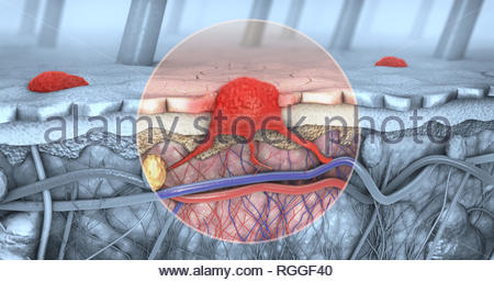 BÖSARTIGER TUMOR DER HAUT Stockfoto, Bild: 49303827 - Alamy