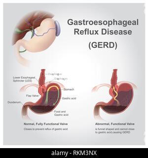 Gastroösophageale Refluxkrankheit GERD, auch als Acid Reflux genannt ...