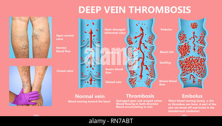 Eine tiefe Venenthrombose (DVT) ist ein Blutgerinnsel (Thrombus), das ...