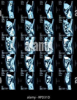 Die Magnetresonanztomographie (MRT) der Brust und Bauch Stockfotografie ...
