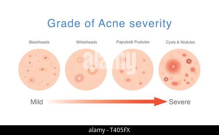 Arten von Akne Diagramm für Hautprobleme Inhalt Stock-Vektorgrafik - Alamy