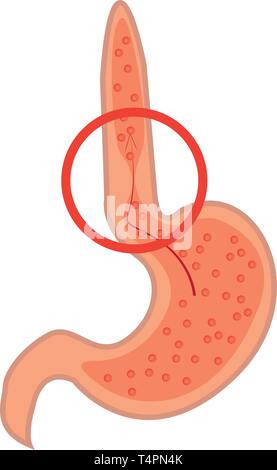 Gastroösophageale Refluxkrankheit Anatomie illustration Stock ...