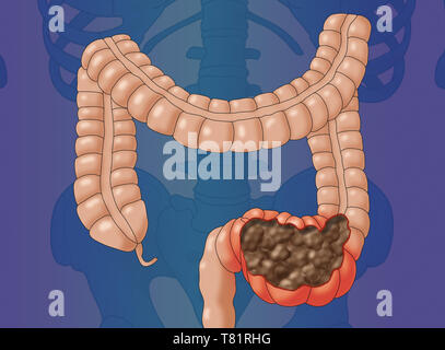 Verstopfung Darm, Abbildung Stockfotografie - Alamy