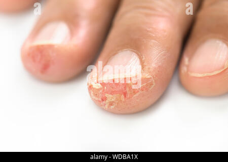 Fortgeschrittenen dyshidrosis an Fingern, Risse und abblätternde Haut ...