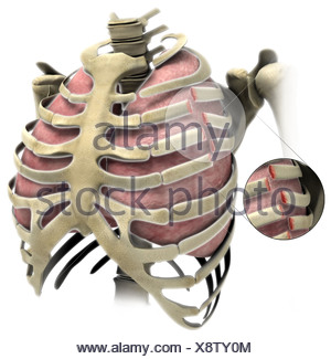 Abbildung einer Rippe Fraktur Stockfotografie - Alamy