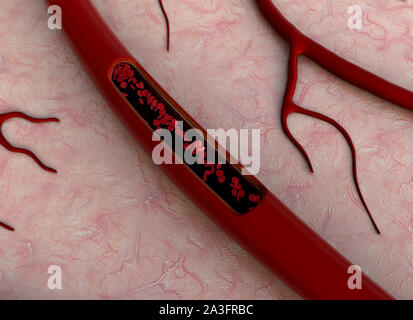 Thrombus ou caillot de sang à l'intérieur d'un vaisseau sanguin, avec ...
