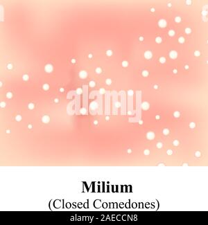 Comedones fermées. Acné sur la peau. Maladies dermatologiques et ...