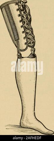 Moignon d'amputation au-dessous du genou Photo Stock - Alamy