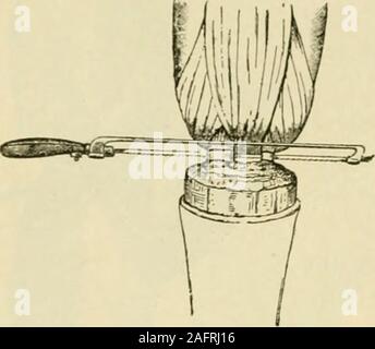 Moignon d'amputation au-dessous du genou Photo Stock - Alamy